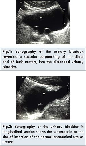 Ureterocele Figure 3 From Prolapsing Ectopic Ureterocele Presenting As